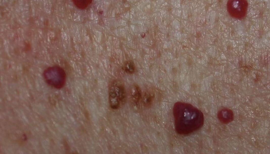 16 Types of Bumps and How to Get Rid of Them - leurr