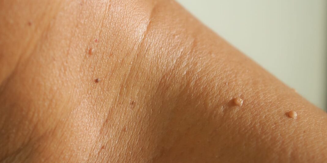 16 Types of Bumps and How to Get Rid of Them - leurr