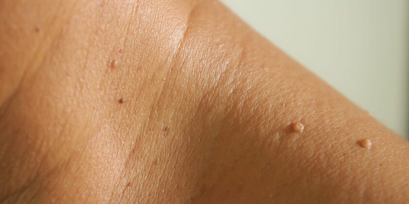 16 Types of Bumps and How to Get Rid of Them - leurr