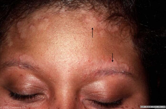 16 Types of Bumps and How to Get Rid of Them - leurr