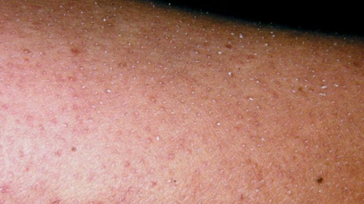 16 Types of Bumps and How to Get Rid of Them - leurr