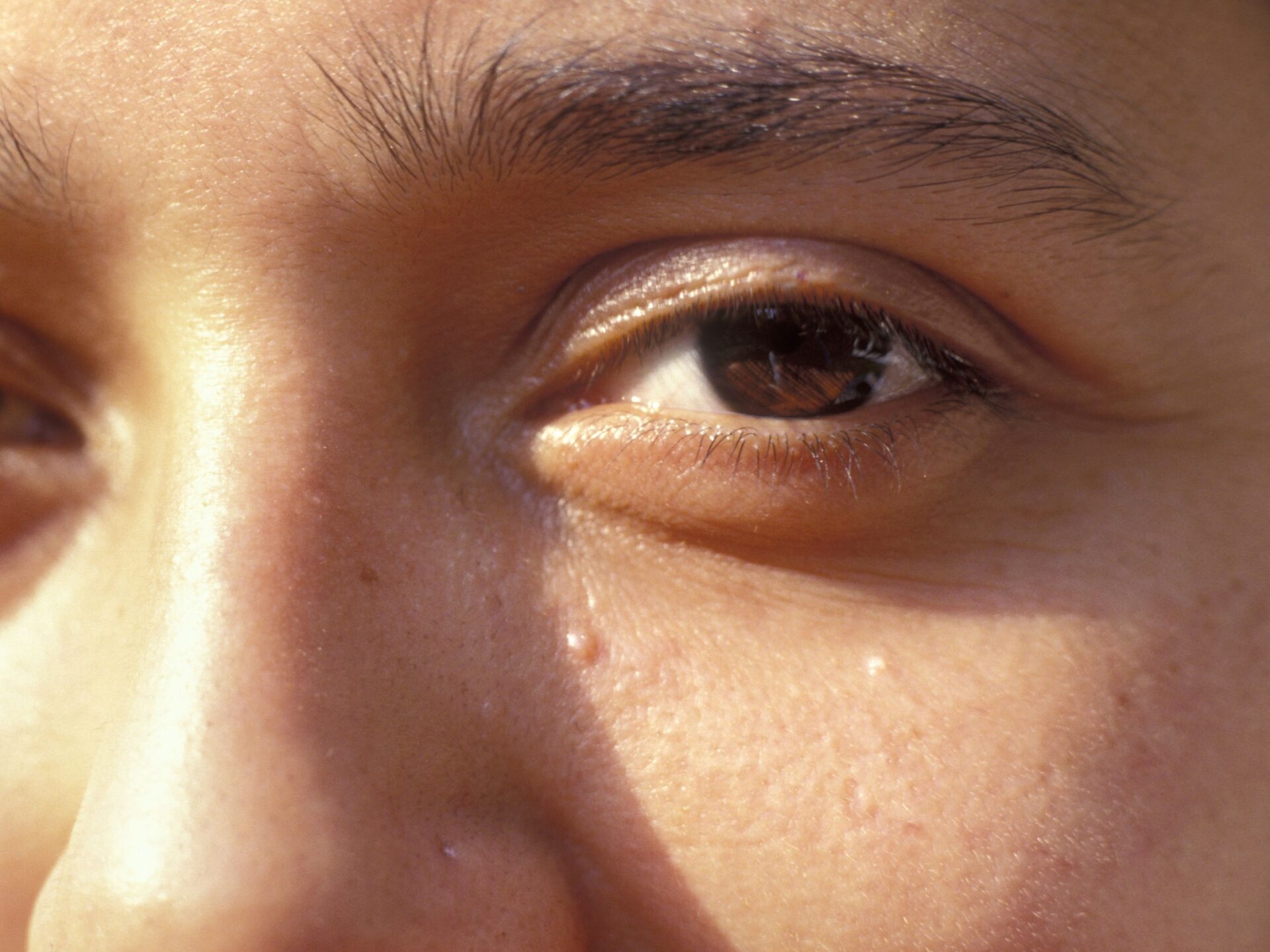 16 Types of Bumps and How to Get Rid of Them - leurr